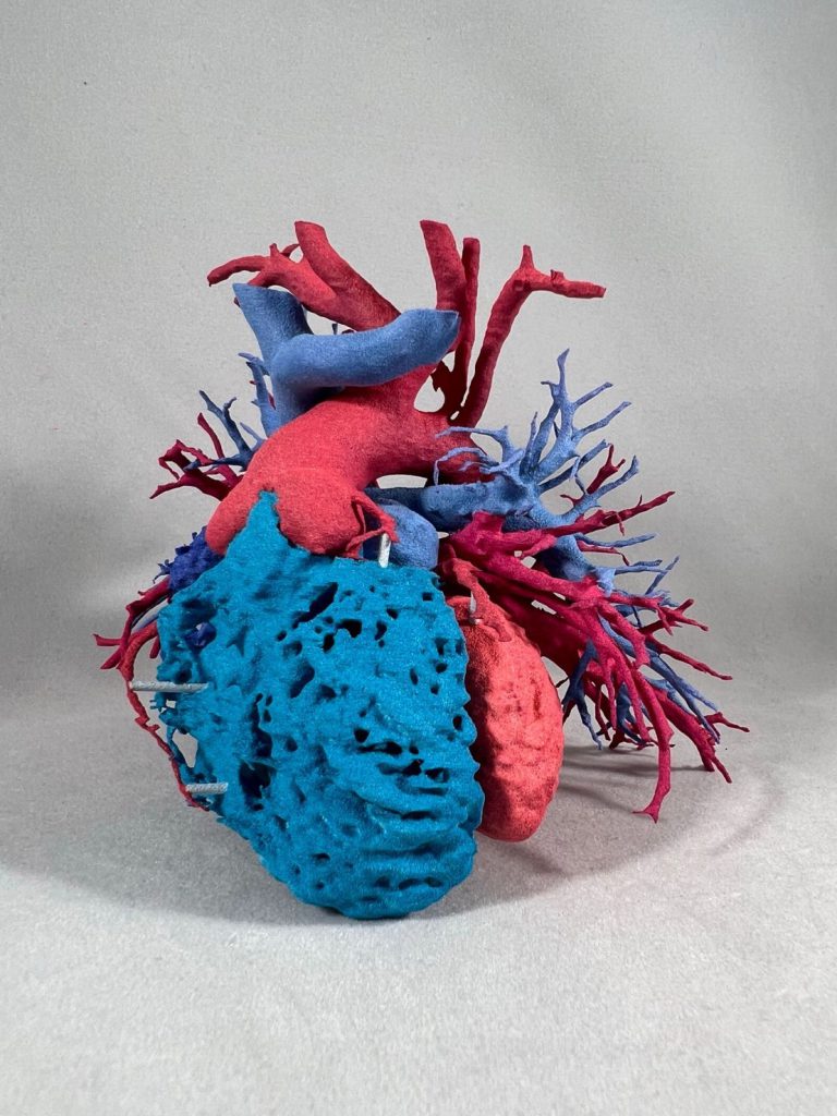 Models created by UPMC 3D Printing Program Improve Patient-Centered ...